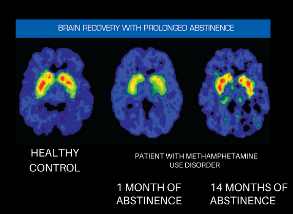 Analyzing N-Acetyl-Cysteine and Its Role in Addiction Treatment and ...