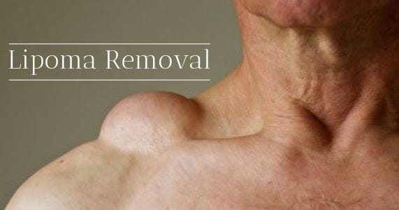LIPOMA. A lipoma is a slow-growing, fatty lump… | by sinchan saha | Medium
