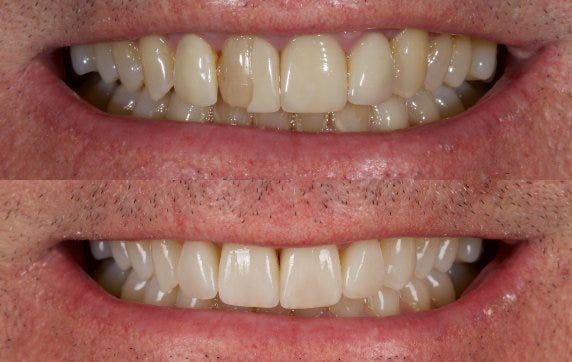 What are veneers and how do they work? | by Onyinyechi Amos | Medium