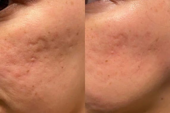 DermaFuse | Acne clearance | | Laser Hair Removal In Georgia | Needle ...