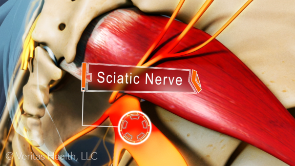 A Brief Overview of Sciatica and Leg Pain | by Dr Luis Lombardi | Medium