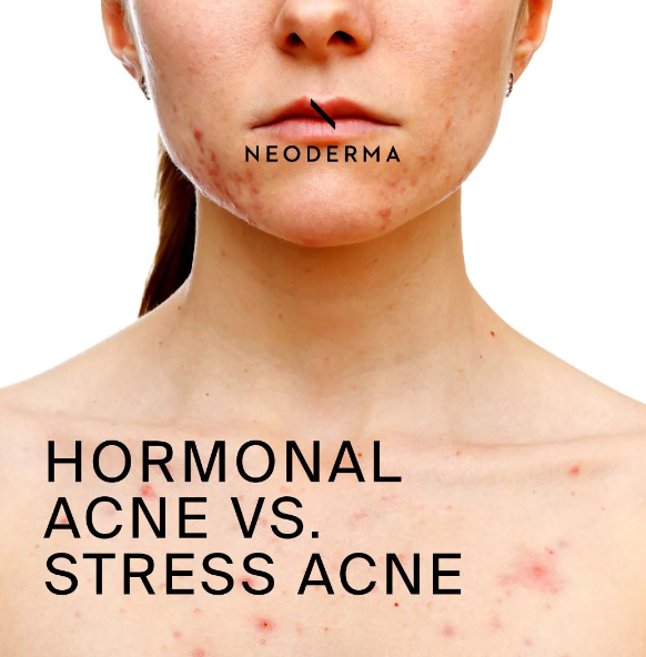 Stress Pimples | NEODERMA. Are you looking for skincare for stress ...