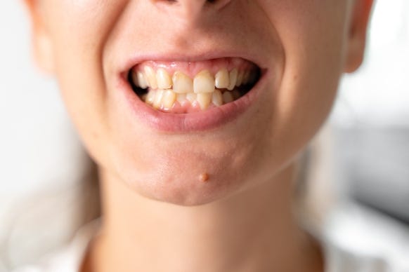 Why are my teeth yellow when I brush them every day | by Abc 123 Dental ...