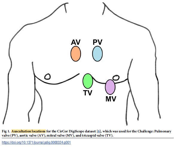 Brief Review — Heart Murmur Detection From Phonocardiogram Recordings The George B Moody