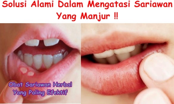 Obat Sariawan Herbal Yang Paling Efektif | by Hana Alifian | Medium