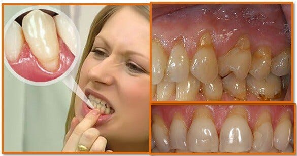 Do Receding Gums Grow Back?. First, the “attached gingiva” connects ...