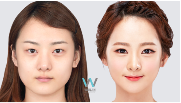 Lewat Operasi Kontur Wajah Korea, Garis Muka U Jadi V | by Vee | Medium