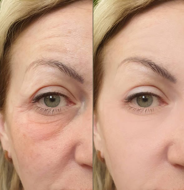 What are the Results of Botox Under Eyes? | by Cosmetic Injectables ...