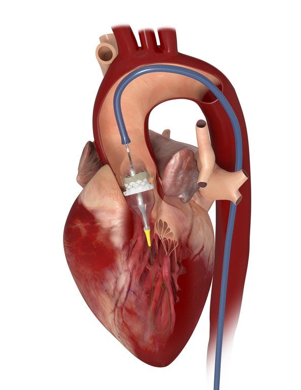 TAVI Market Innovations: Pioneering the Future of Minimally Invasive ...