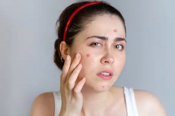 Does Pre Workout Cause Acne? - Florida Independent - Medium