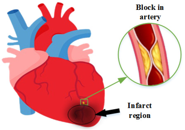 Myocardial Infarction Market Size, Share, Growth Forecast 2032 | by ...