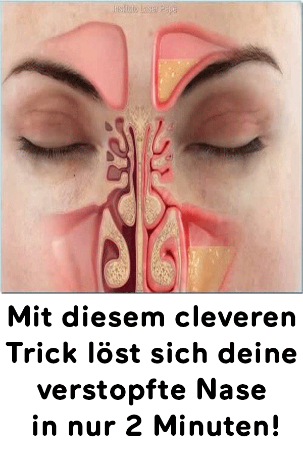 Zwiebel Verstopfte Nase