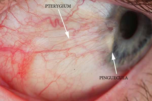 Tests and Diagnosis of Pterygium? | by digital | Medium