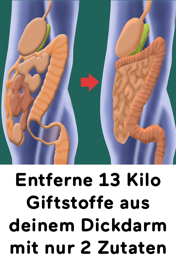 Entferne 13 kilo giftstoffe aus deinem dickdarm mit nur 2 zutaten ...