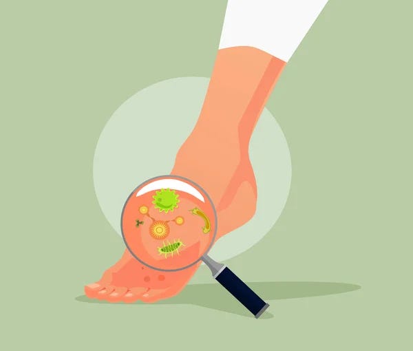 Different kinds of Fungal Infections, tinea pedis, Hyperkeratotic ...