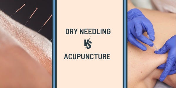 Dry Needling vs Acupuncture. Dry Needling vs Acupuncture… | by Keep in motion physio | Feb, 2024 ...
