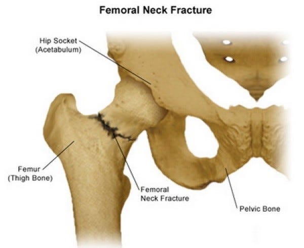 Femoral Neck Fracture Physiotherapy | by Wohl Physio | Medium