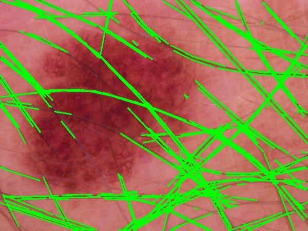 Hair removal from the HAM dataset | by Francode77 | Medium