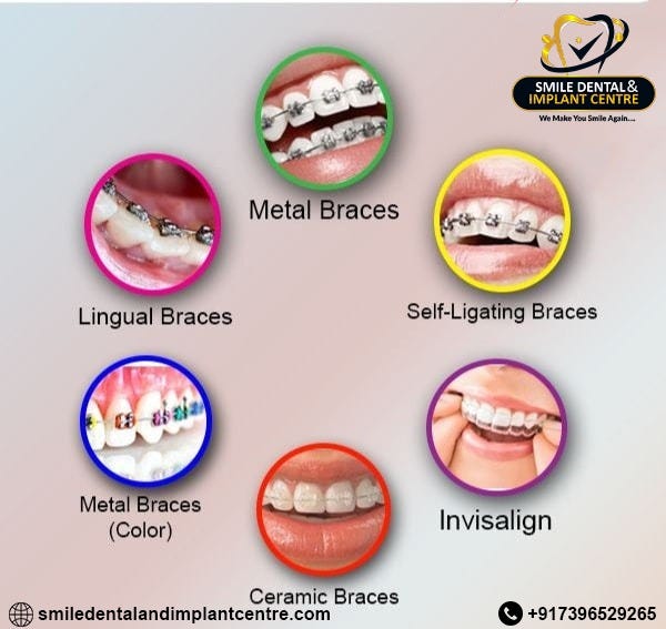 Discover the Best Braces for Your Smile — The Secret to the Perfect ...