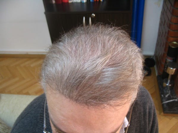 Do you want your Hair back — Take Hair Transplant Help | by FUE ...