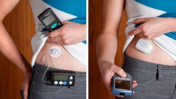 Tubeless Insulin Pump Market expand by 2019–2025 striking growth ...