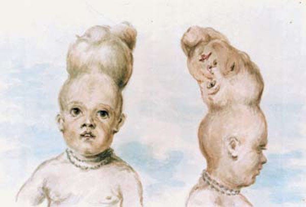 The Boy With Two Heads. A curious case from Medical History | by Ben ...