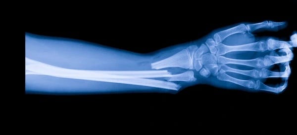 Enhancing Osteoporosis Management with PEMF Therapy: Benefits and ...