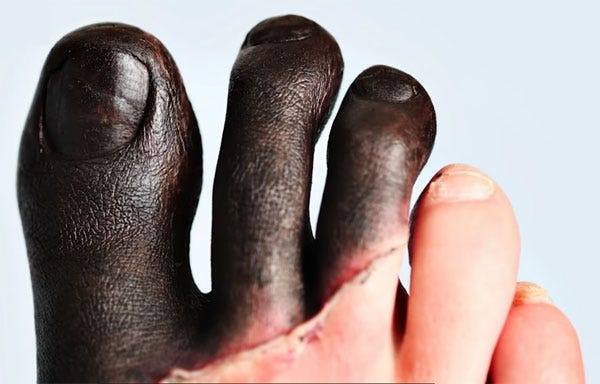 Diabetic Foot Ulcer: Diabetic Wound Treatment and Prevention | by ...
