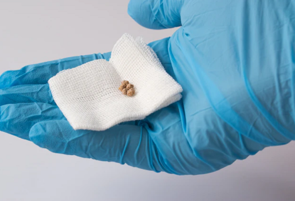 Comprehensive Guide to Gallbladder Surgery: Everything You Need to Know ...