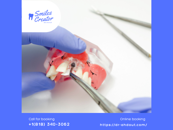 Restoring Function and Beauty: The Benefits of Dental Implants at Dr ...