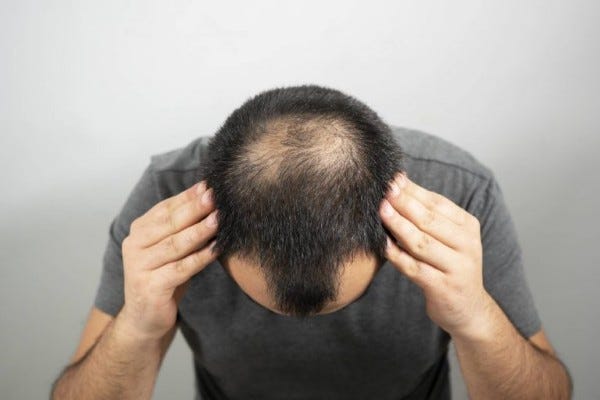 10 Surprising Reasons for Hair Loss | by Jessica Cram | Medium