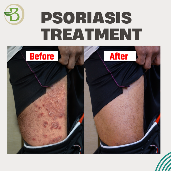 Comprehensive Guide to Effective Skin and Scalp Psoriasis Treatment | by Bharat Homeopathy | Apr ...