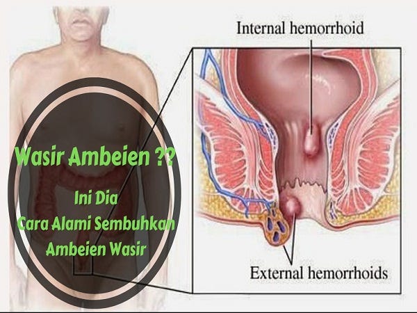 Apa Itu Wasir Akut. Apa Itu Wasir Akut — Setiap orang pasti… | by Cara Sembuhkannya Ambeien ...