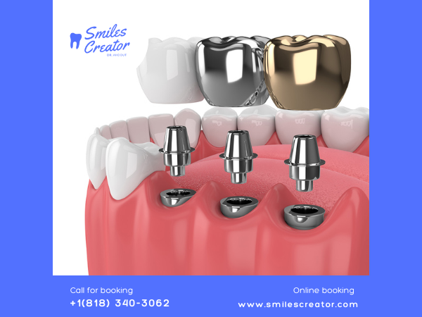 Dental Implants: Beyond Aesthetics, Enhancing Oral Health with Smiles ...