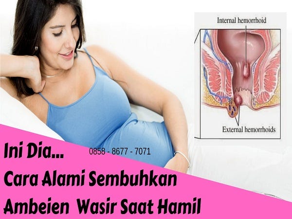 Cara Mengatasi Wasir Pada Ibu Hamil | by Cara Sembuhkan Ambeien | Medium