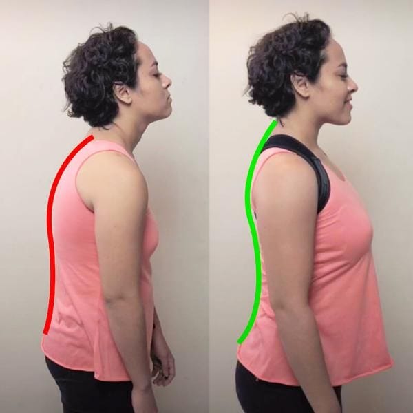Posture Disorders Surgery Treatment in Turkey - Plastic Surgery Turkey ...