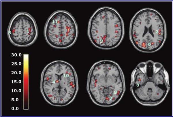 How HBOT Helps In Treating Traumatic Brain Injury | by Chloe Paltrow ...