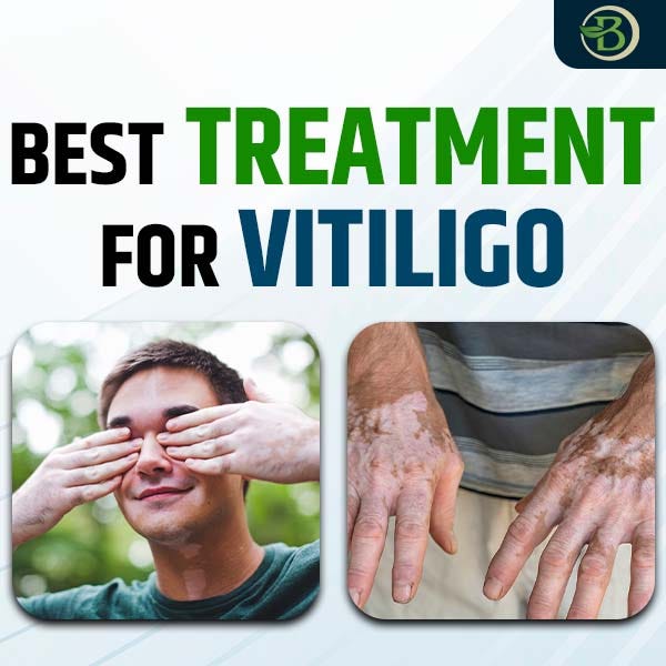 Vitiligo Medication: Treatment for White Spot on Skin & Lips With ...