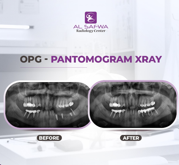 Don’t Let Impacted Teeth Ruin Your Smile — Book an OPG Scan at AlSafwa ...