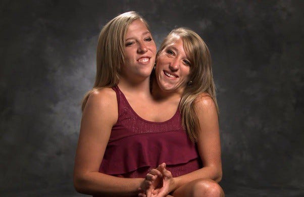 Conjoined Twins Born With One Body
