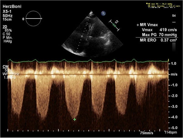 Doppler echocardiogram. Introduction : | by Anusree chandra | Jul, 2023 ...