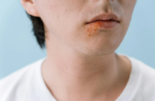 Managing Boils and Abscesses: Symptoms and Home Care Tips | by ...