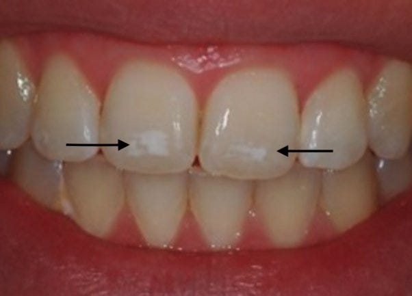 White Spots on Teeth after Braces Treatment | by Dentology | Medium