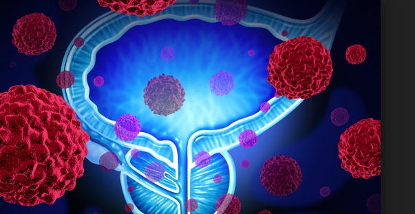 Metastatic Prostate Cancer Detailed Overview & Treatment | by Avantika ...