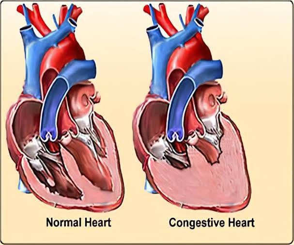 Understanding Congestive Heart Failure: Causes, Symptoms, and Treatment ...