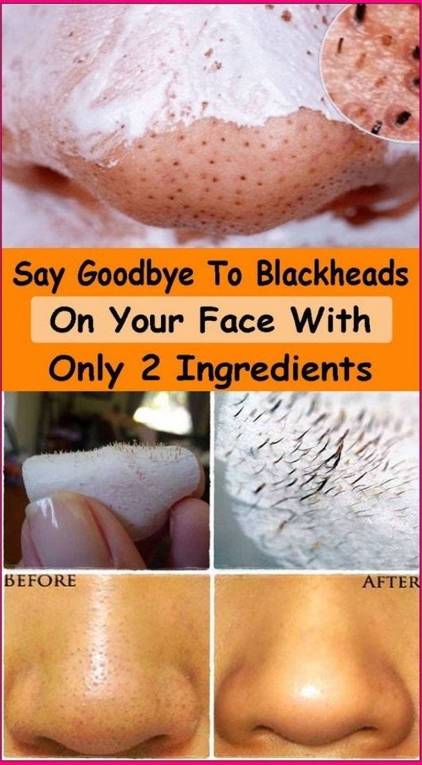 Say Goodbye to Blackheads on Your Face With Only 2 Ingredients ...