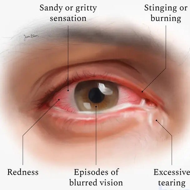 Causes And Treatment Options For Dry Eye Syndrome | by Mylumineyes ...
