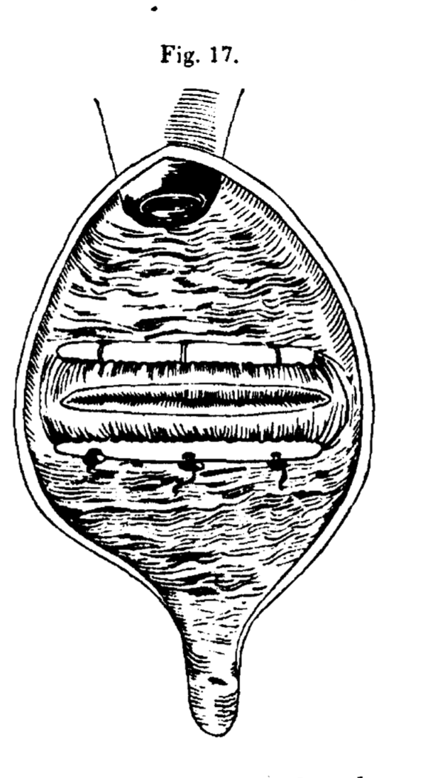 CHAPTER NINETEEN — THE CLAMP SUTURE | by J.C. Hallman | Medium
