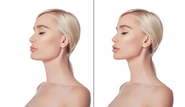 The Benefits and Risks of Chin Filler Before and After Results You Need ...