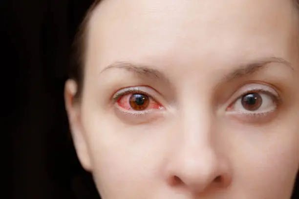 EYE FLU ( PINKY EYES). Highly Contagious Infection…. | by Zehra Amir ...